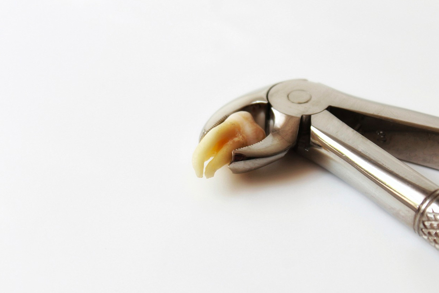 Warning Signs That You May Need To Have A Tooth Extracted | CharterMeNow